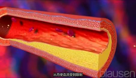 你知道血栓是如何形成的吗?