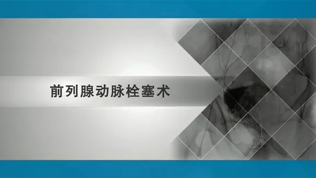 前列腺动脉栓塞术手术演示,你不一定看懂,但你应该告诉更多人