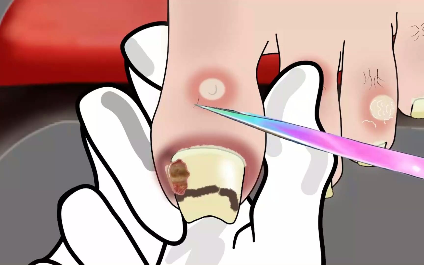 【沉浸式修脚】逼真的内嵌脚趾甲护理动画