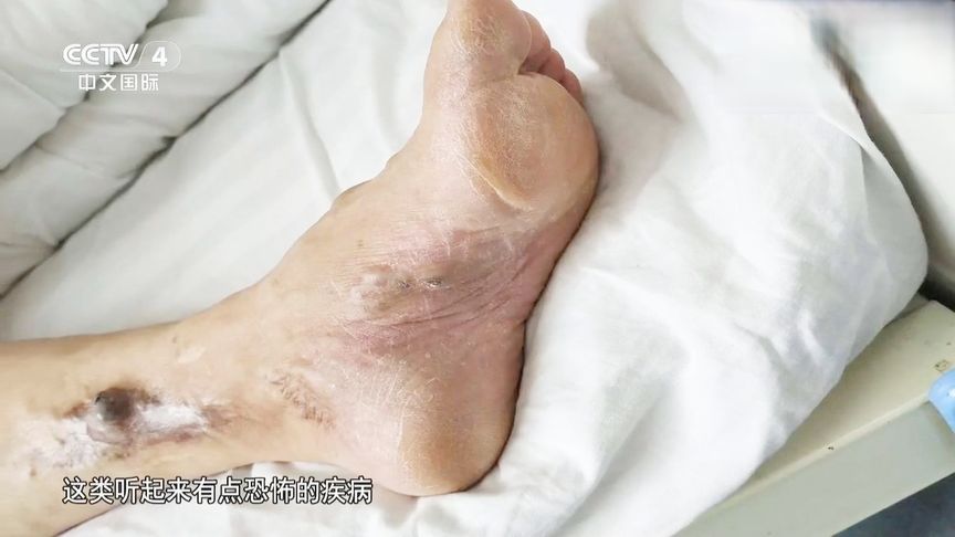 男子腿上红斑溃疡腐烂,医生却说他的病不在皮肤在血管,怎么回事