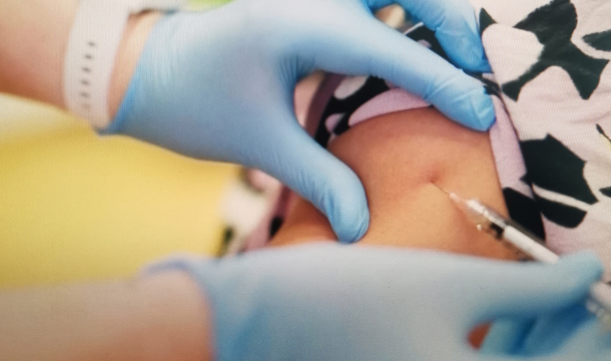 [今日亚洲]卡介苗有助预防新冠病毒?多国启动临床试验