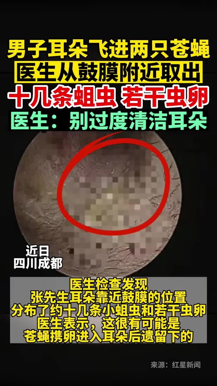 成都一男子耳朵取出十几条蛆虫和若干虫卵!医生提醒:别过度清洁耳朵!