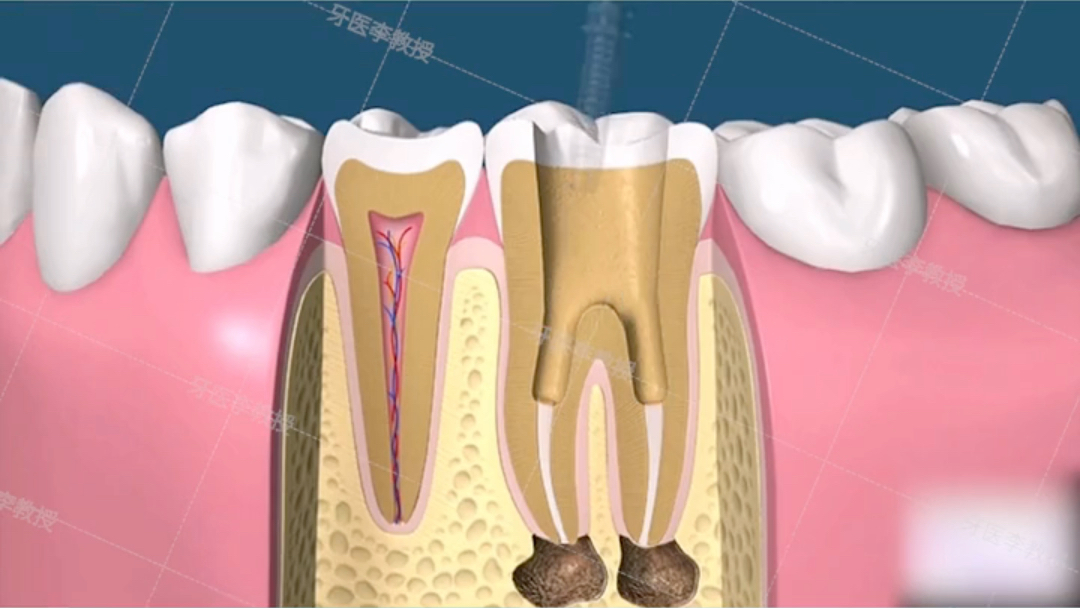 桩冠修复一颗烂牙,一起看看吧