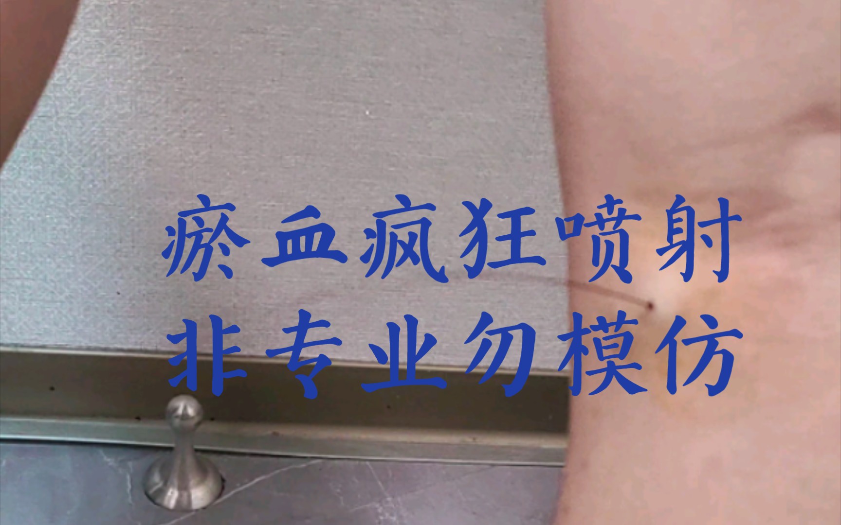 阴谷穴刺血实操,瘀血疯狂喷射!