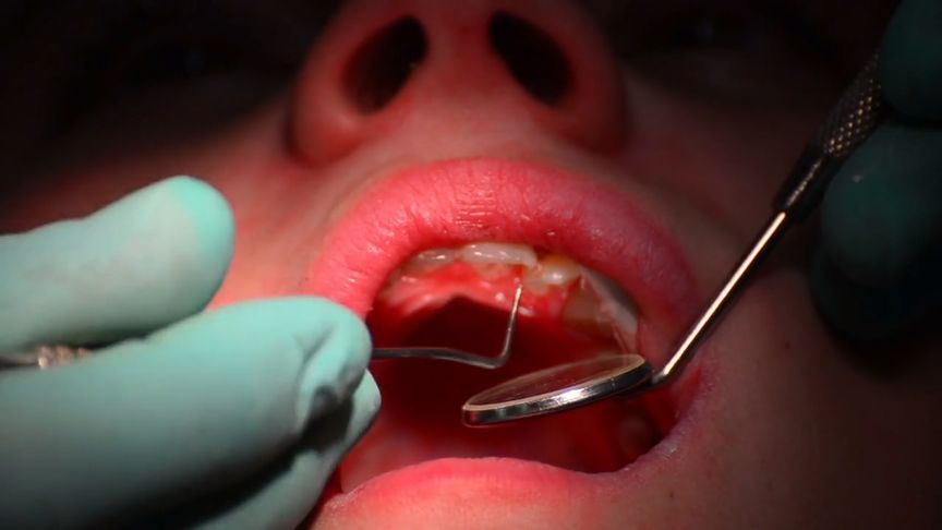 牙疼或真要命!小伙牙疼3天自行吃药后进ICU,纵隔感染两周才出院