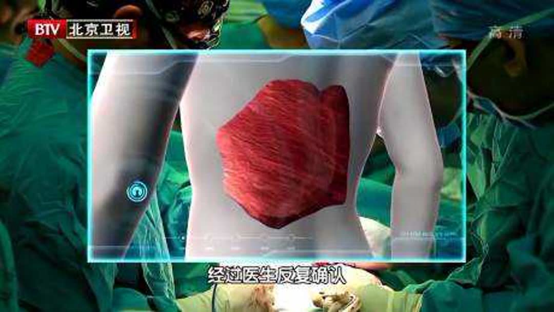 女孩背后肿瘤布满血管,怎料医生刚一下刀,血流如柱!