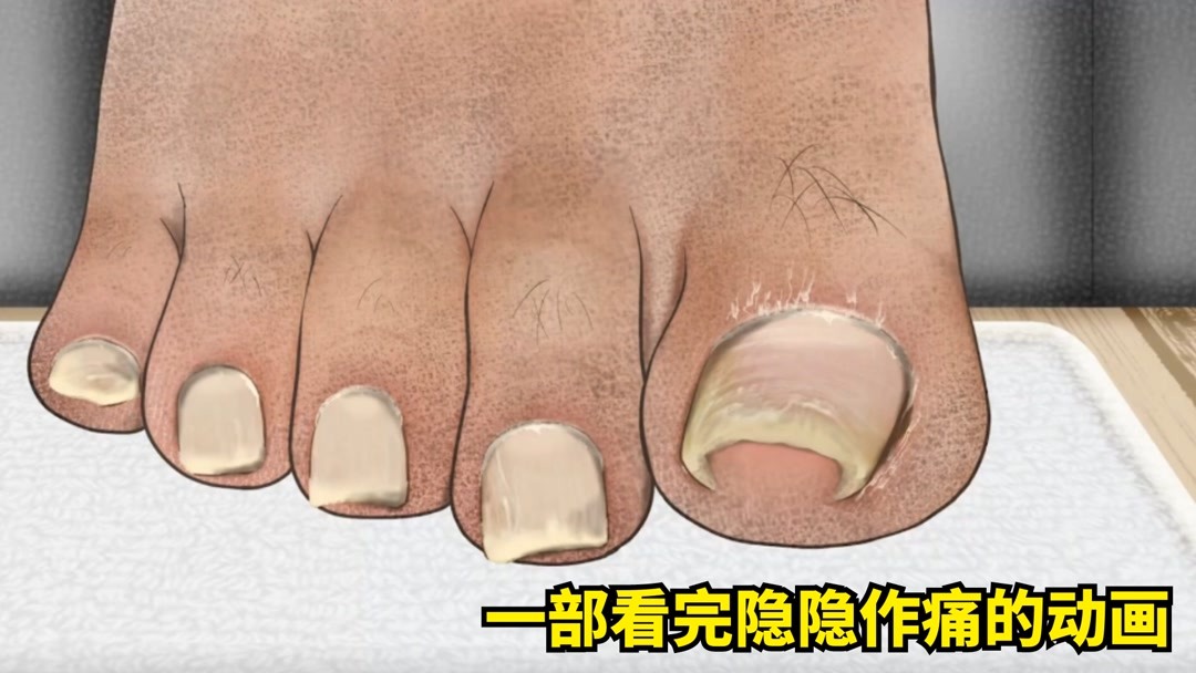 高分科普解压动画!1分钟告诉你如何修理脚指甲,看完隐隐作痛