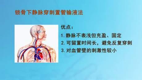 217.锁骨下静脉穿刺置管输液优点和适应证