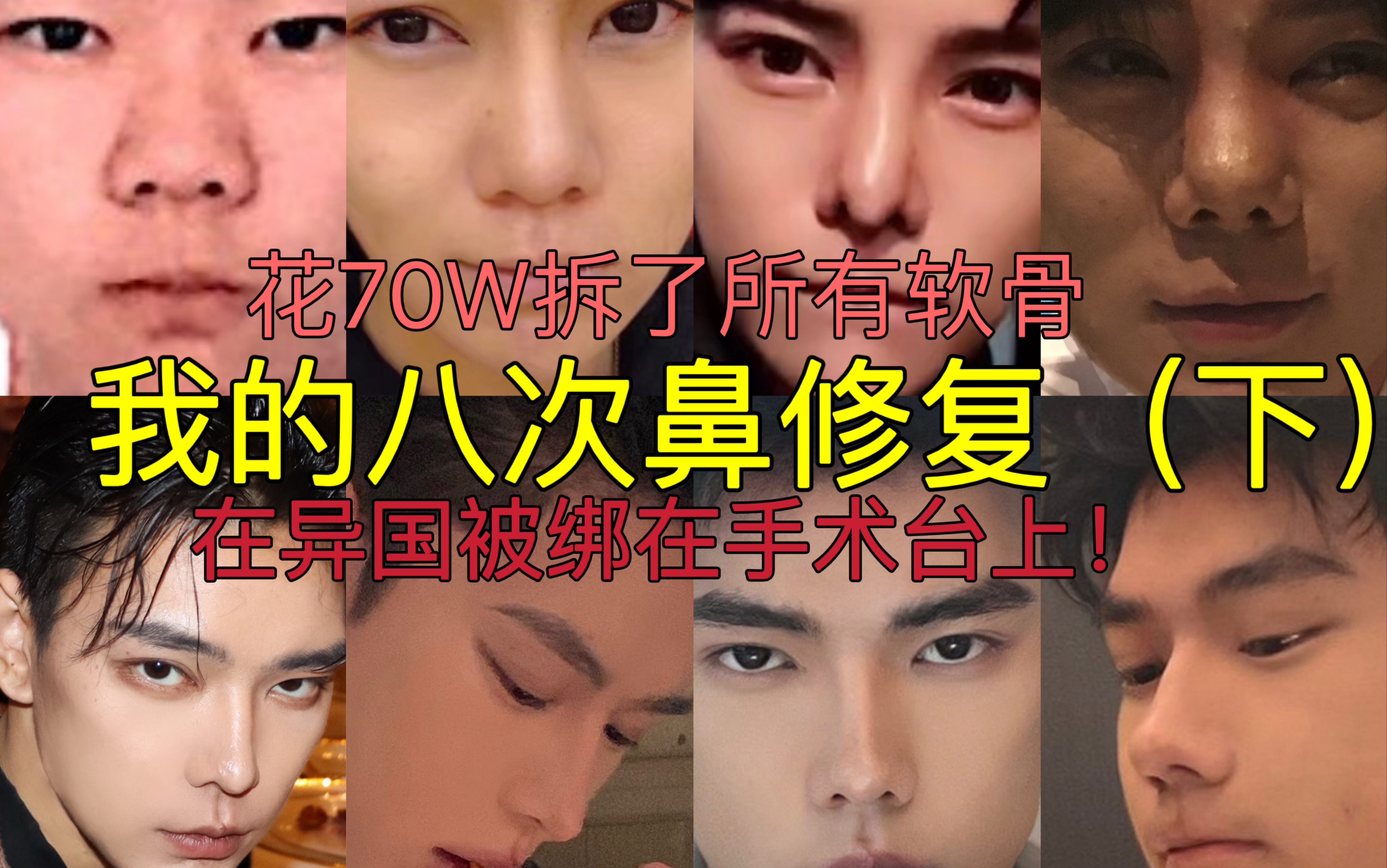 我的八次鼻修复手术经历(下)在异国被绑在手术台上强行手术!
