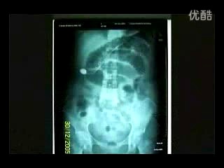 营养治疗视频教程:液囊空肠导管在术后炎性肠梗阻中的应用(临床资料)