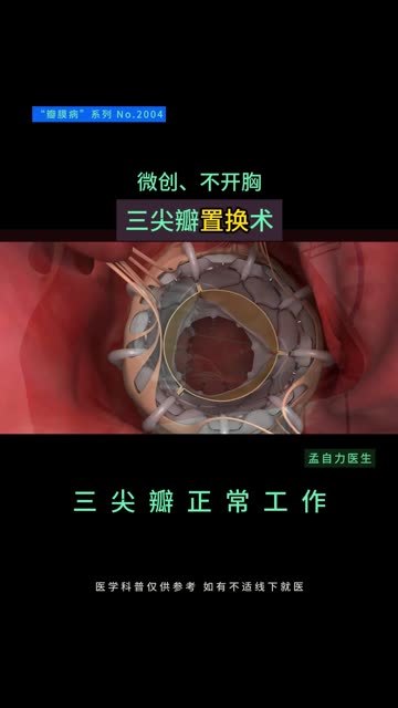 微创 不开刀三尖瓣置换术 @快手光合计划助手(O3xxpf2m4brbf3pe) @...