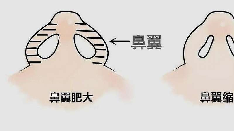 隆鼻手术是怎样进行的?3D动画模拟全过程,隔着屏幕都觉得疼!