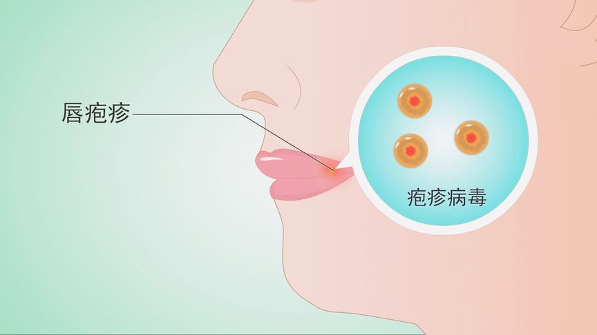 嘴巴上火起泡 老中医说这些方法都能快速消除!