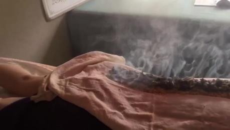 铺姜灸 三伏灸 艾灸