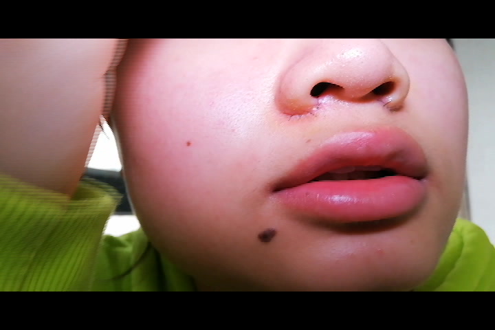 4月16-17,鼻翼缩小5天