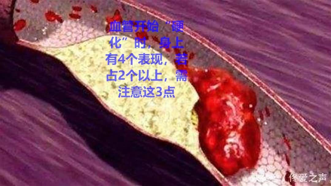 血管开始"硬化"时,身上有4个表现,若占2个以上,需注意这3点