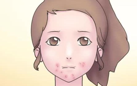 痤疮治疗动画