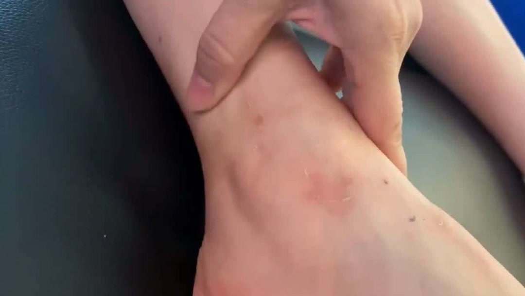 中医董氏奇穴三重穴-主治甲状腺肿大、眼球突出、扁桃腺炎
