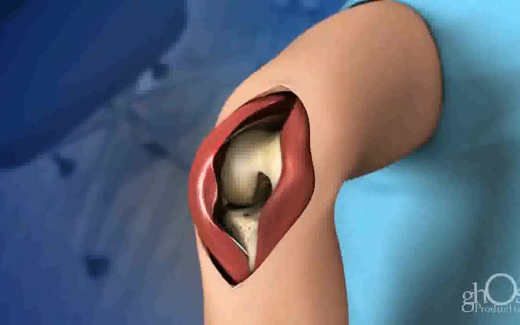 【3D医学动画】千万不要自行带入!膝关节置换