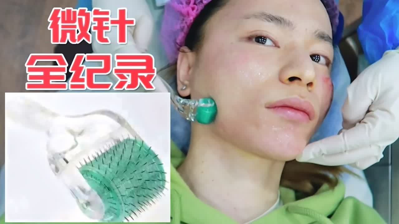 微针超详细过程恢复全纪录|无数针头扎进皮肤能修复肌肤?