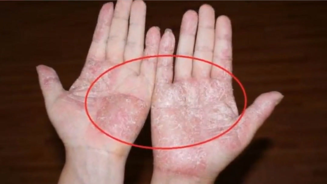 为什么有些人的手一换季就容易脱皮?究竟是怎么一回事?涨知识