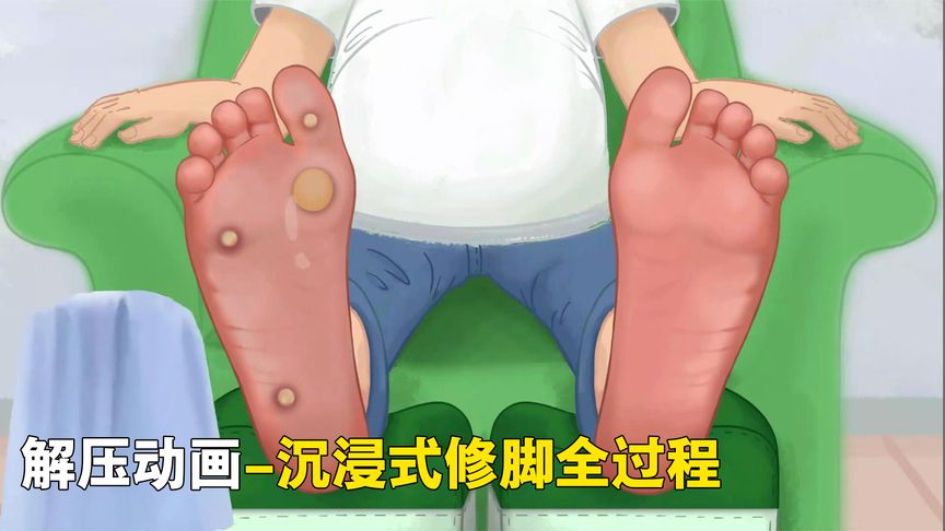 解压动画:沉浸式修脚全过程,医生切除鸡眼死皮老茧,爱护双脚