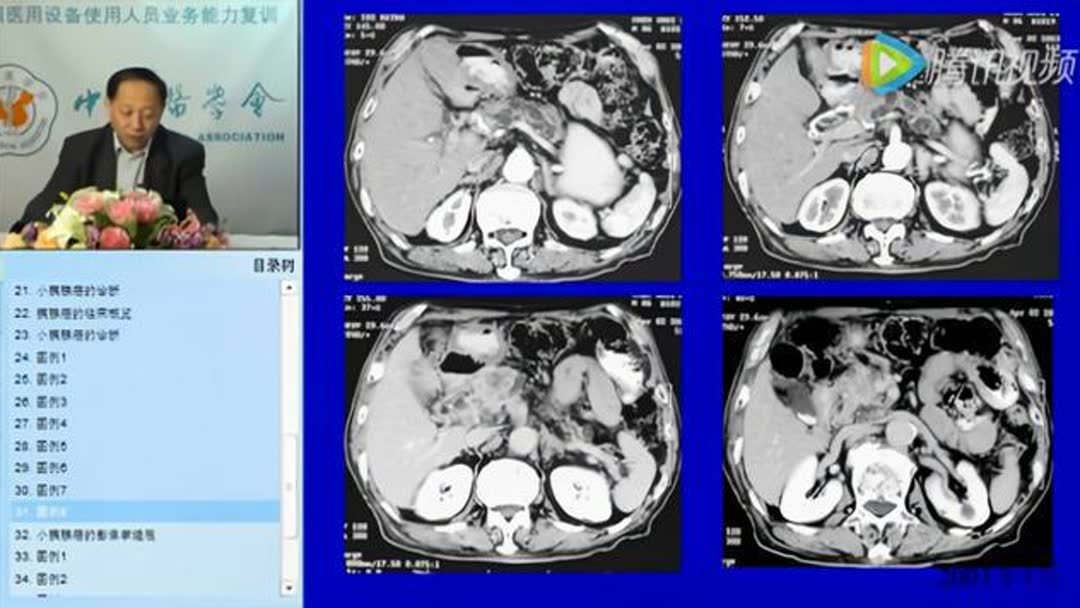 【精品-腹部:胰脾病变】胰腺肿瘤的临床病理分类及CT检查进展