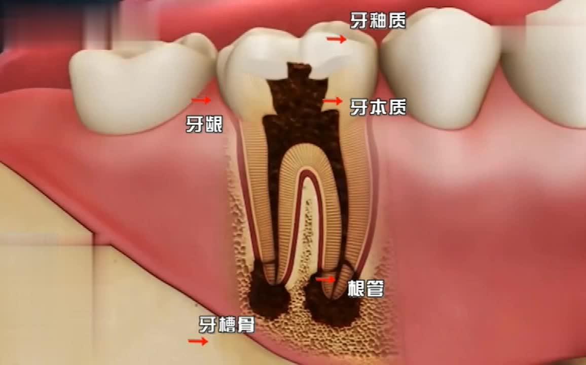 2分钟动画看懂牙齿根管治疗全过程