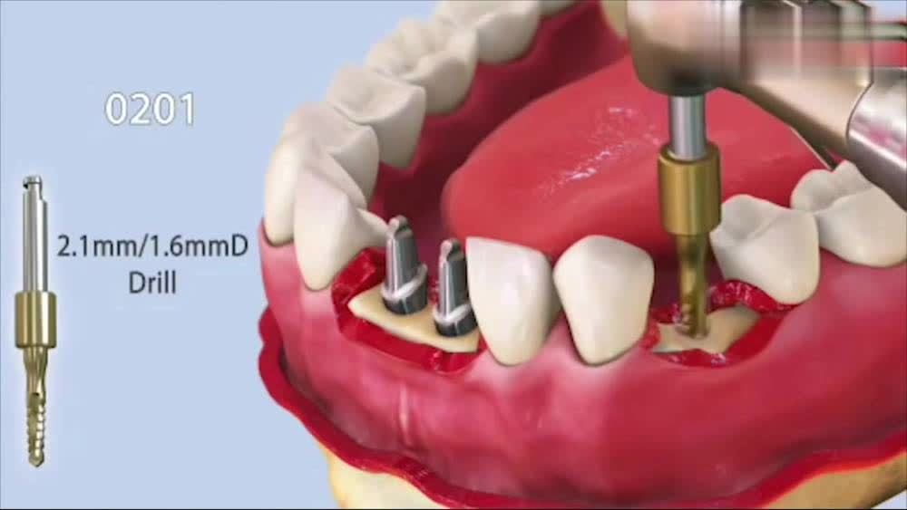动画演示种牙,我隔着手机屏幕都感到疼!