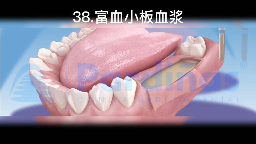 38.富血小板血浆,关于富血小板血浆(PRP) 或富生长因子血浆