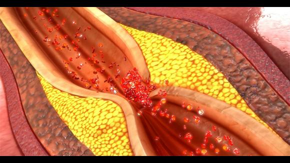 血管堵,身体先知,若出现3个异常迹象,说明你的血管“垃圾多”