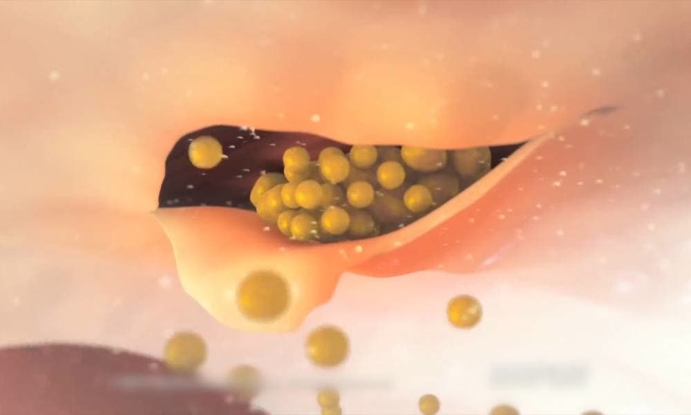 血管硬化危害多!医生提醒:想要逆转血管硬化,做到这3点就行