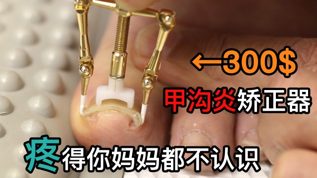新型甲沟炎矫正器,光看看都觉得肉疼啊