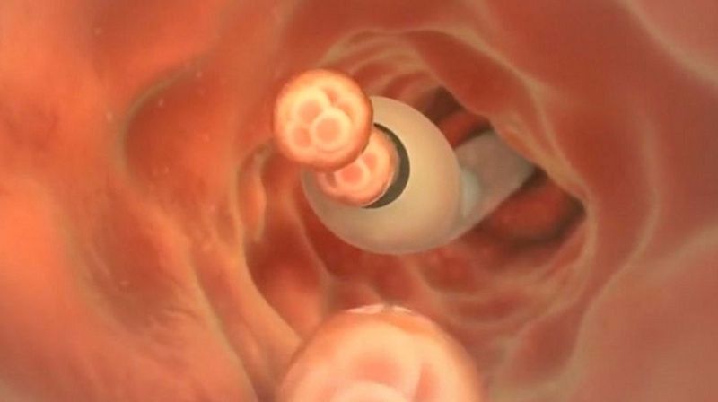 女子做试管婴儿全过程,做女人真是不容易啊,心疼女人!