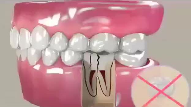 根管治疗后要做牙冠吗?
