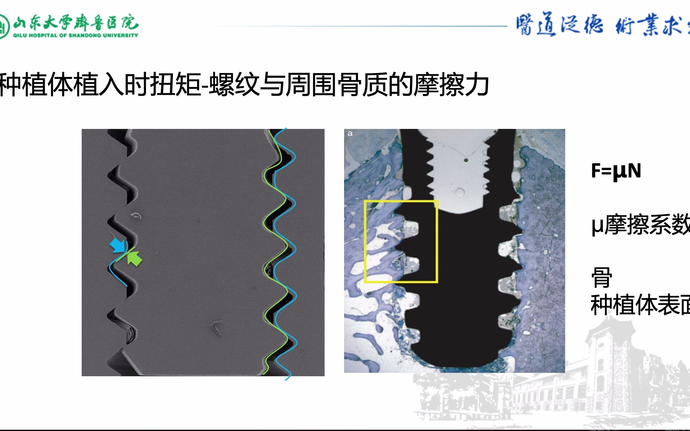 无牙颌种植体选择考量