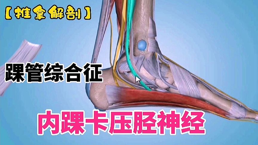 内踝卡压胫神经引起足部疼痛——踝管综合征【推拿解剖】