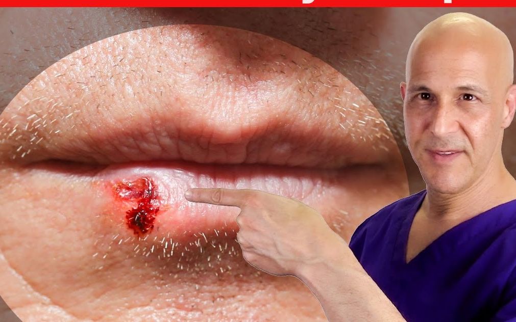 如何健康有效处理唇部疱疹?【Mandell博士】