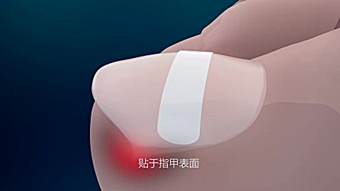 脚医生甲沟嵌甲矫正器炎正甲贴拉拉脚趾甲贴片指甲剪钳修脚刀套装