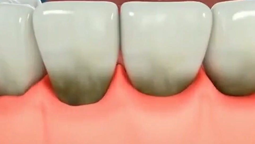 龈下刮治对牙龈萎缩有帮助吗 龈下刮治过程是怎么样的||贝杰口腔