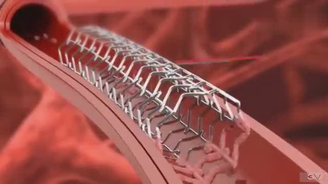 医学3D动画演示:心脏冠脉支架放置过程