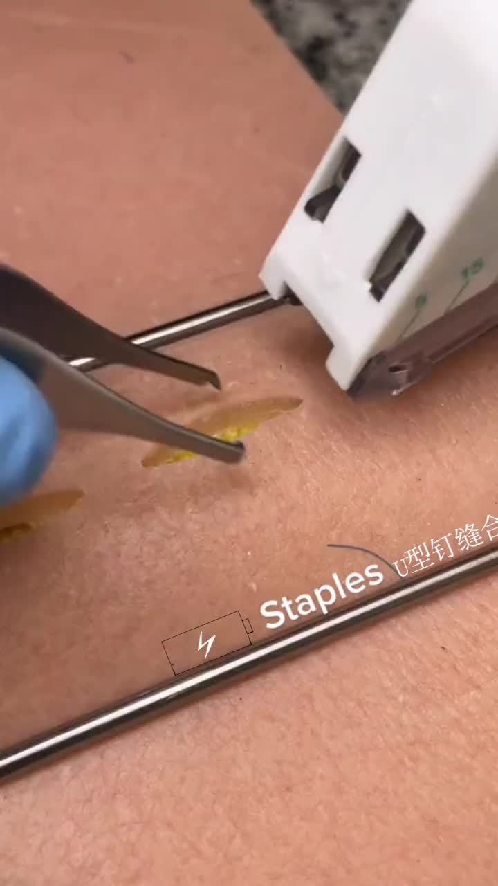 U型钉(快速)缝合,像订书机一样的迅速缝合伤口