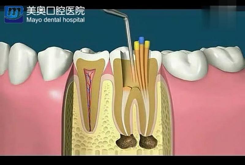 根管治疗过程(动画演示)