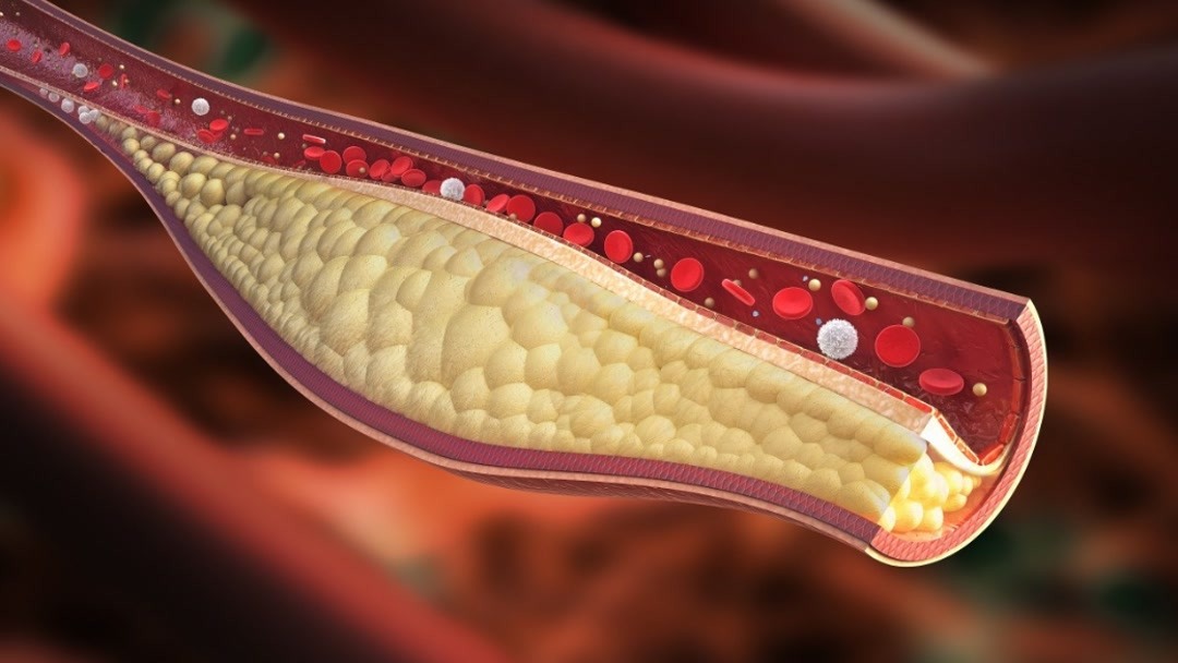血管通畅的人,身上多会有4个明显“特征”,若你有,脑梗还很远