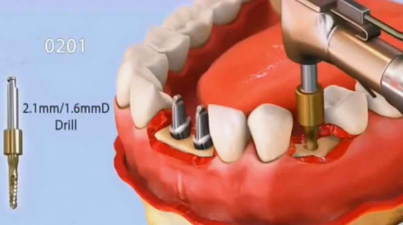 3D动画模拟种植牙全过程,看着就疼系列