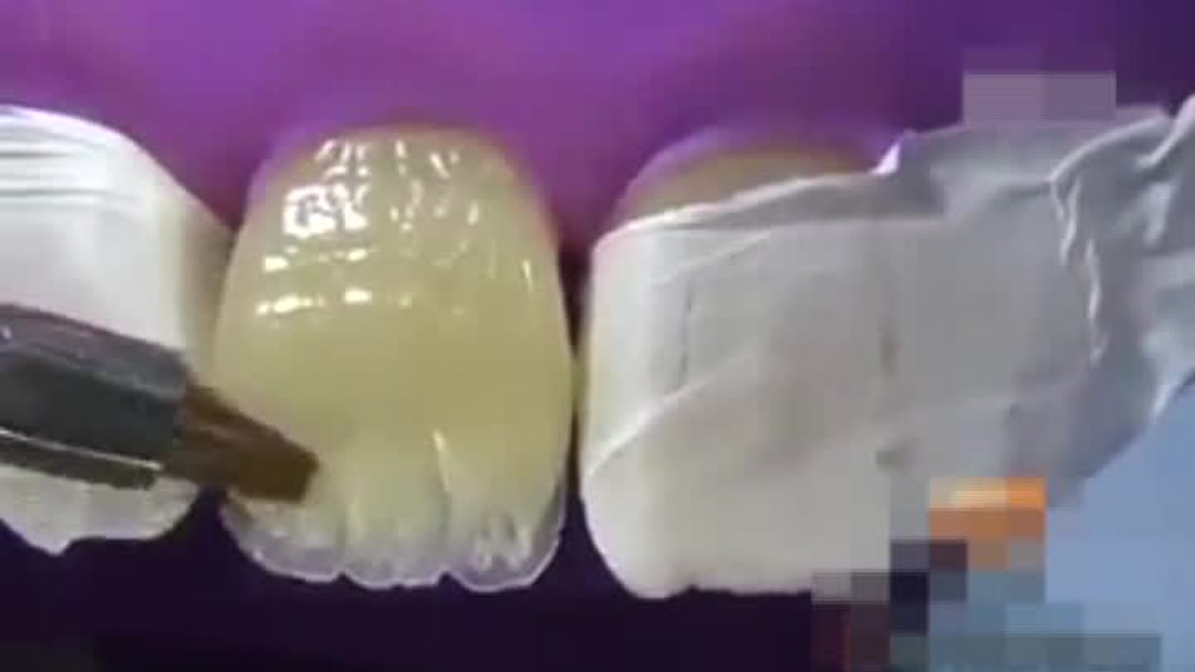 好厉害的断牙修复术 补牙手术 牙齿断裂要怎么修补?