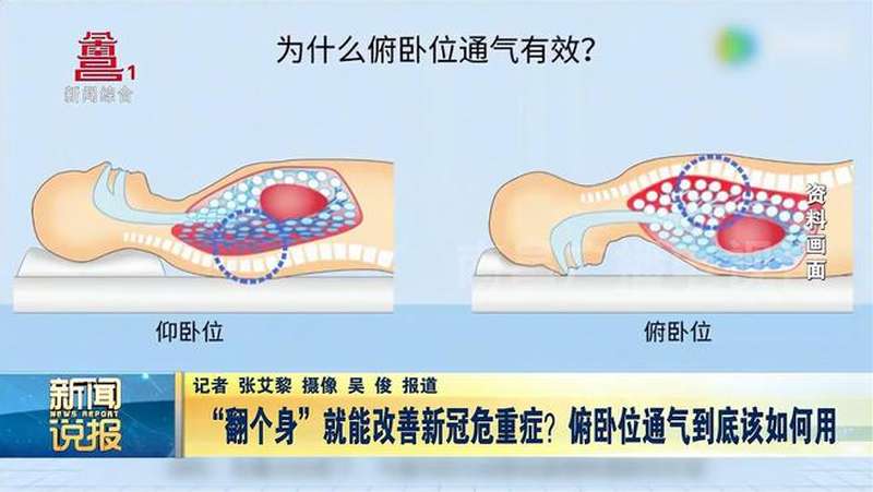 “翻个身”就能改善新冠危重症?俯卧位通气到底该如何用