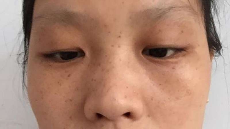 中国女人最容易长斑!皮肤科专家带你找到长斑的原因,你知道吗