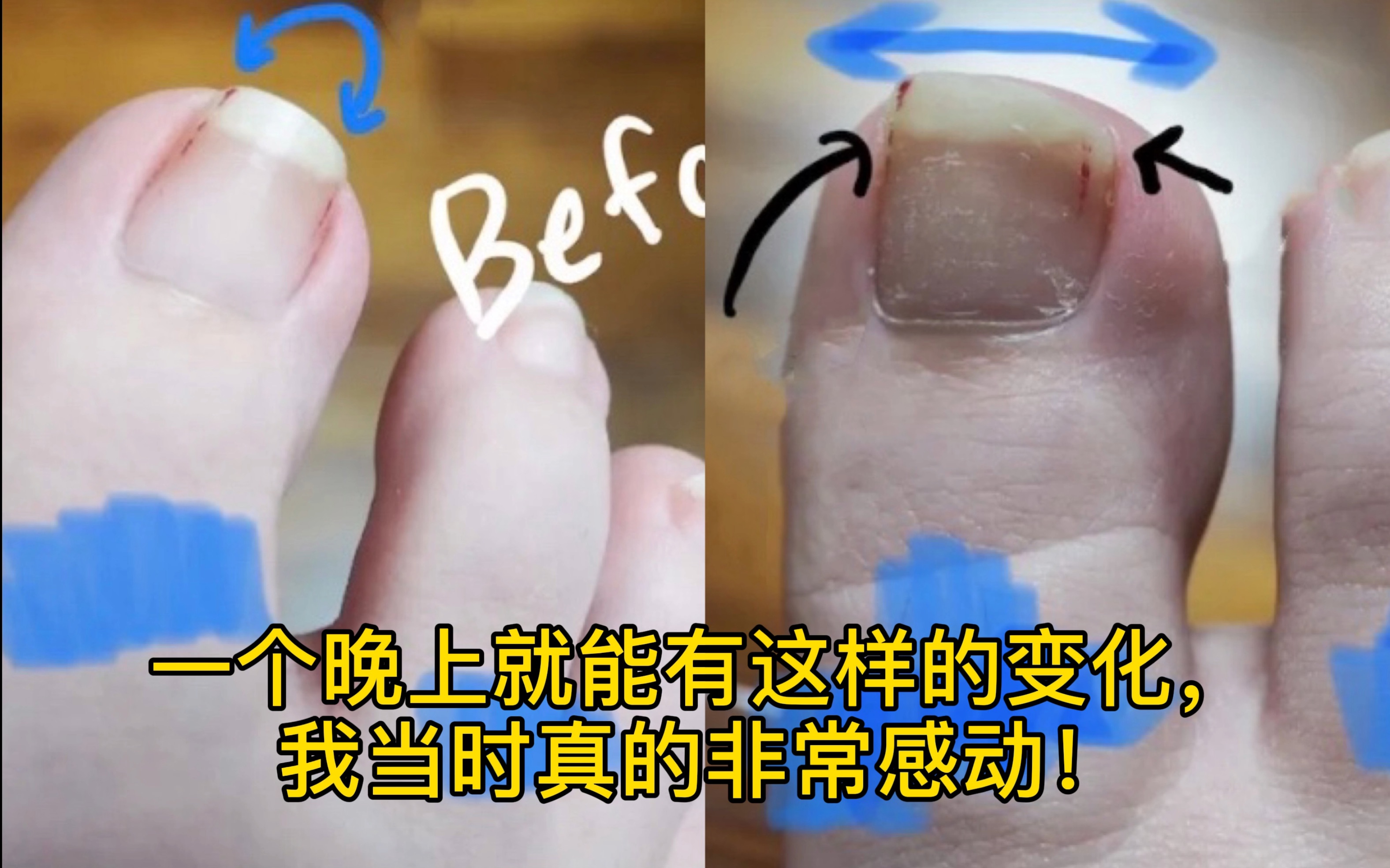 小井卷甲矫正器使用过程全记录(历时一个月)折磨我六年的甲沟炎,终于...
