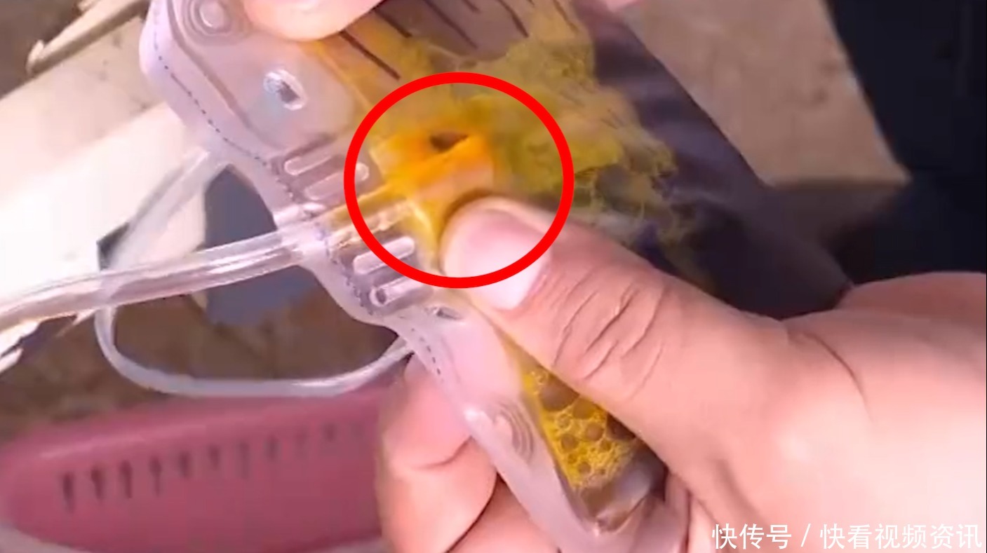 太吓人!广西男子吃鱼生32年,身上插导管亲眼看见虫子爬出体内